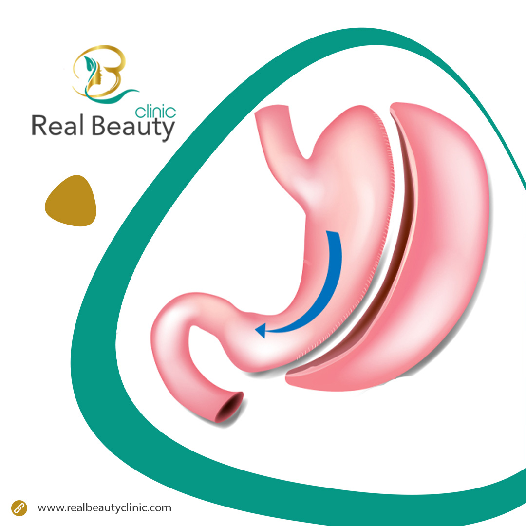 Explaining the gastric sleeve procedure - Real Beauty Clinic
