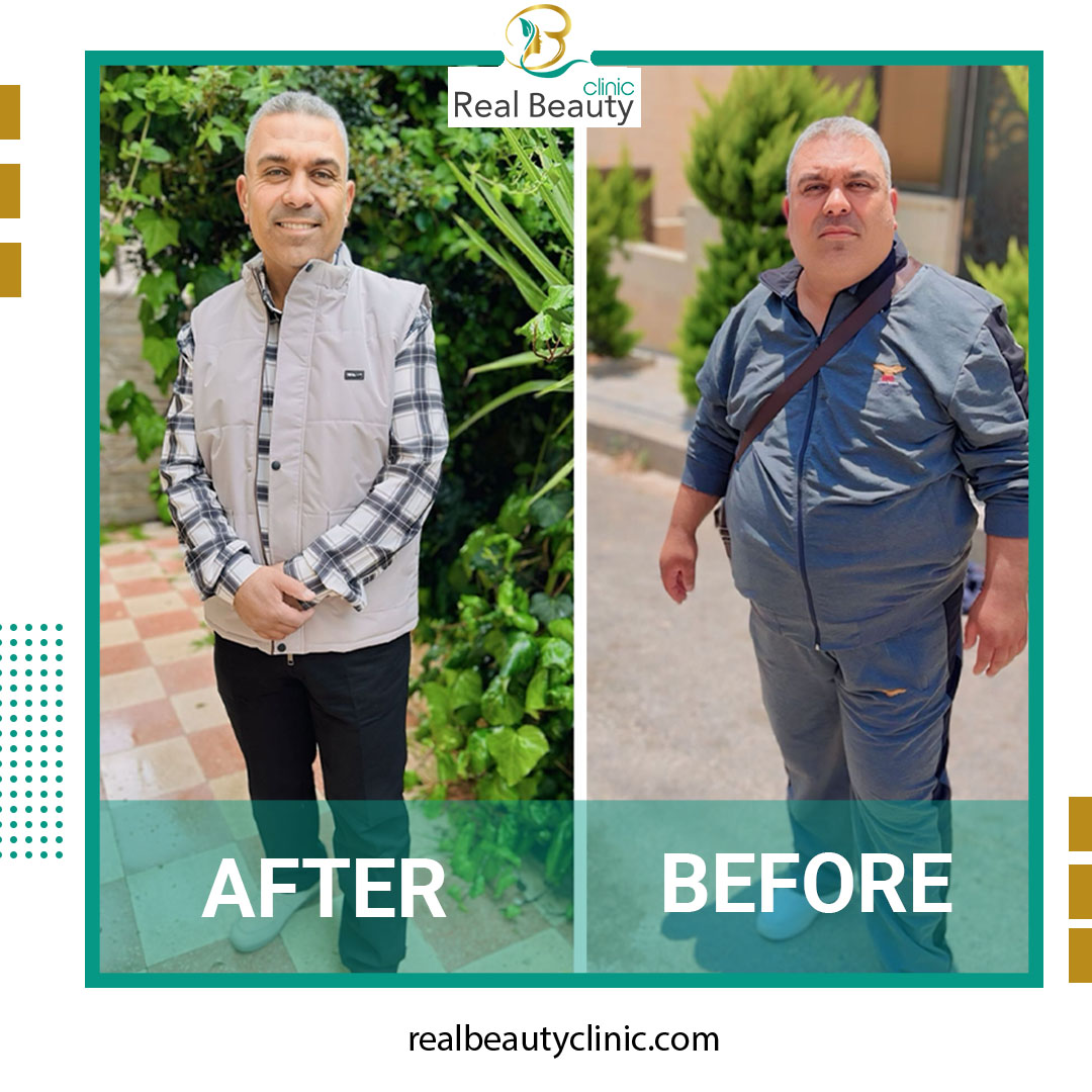 Gastric sleeve results in Turkey - Real Beauty Clinic