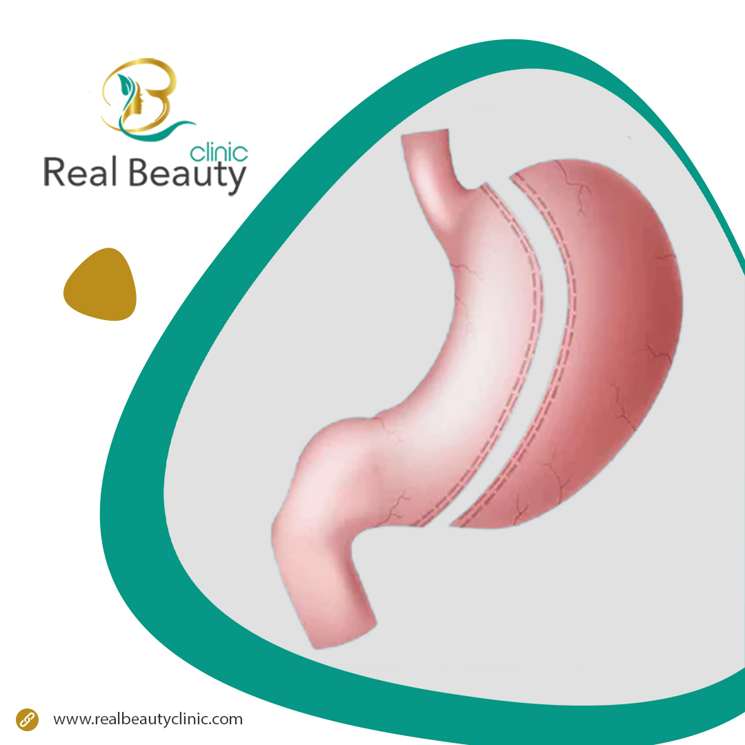 Laparoscopic sleeve gastrectomy: Non-surgical method for losing weight ...