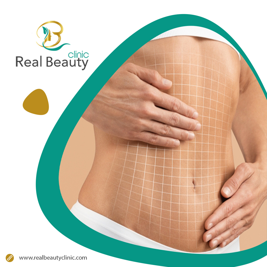 Tummy Tuck After Twins: How to Restore Your Midsection Post-Multiples ...