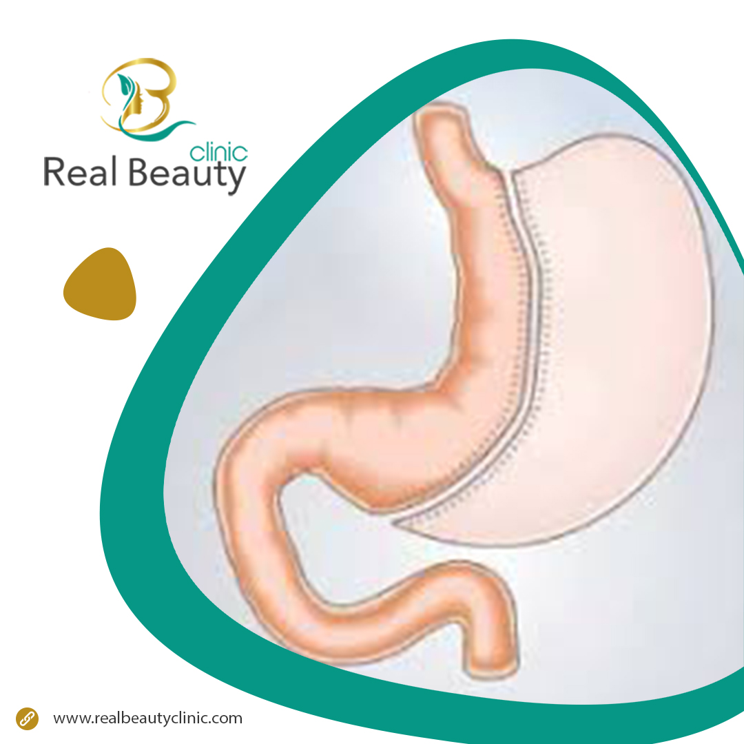 When does the stomach heal after sleeve gastrectomy? - Real Beauty Clinic