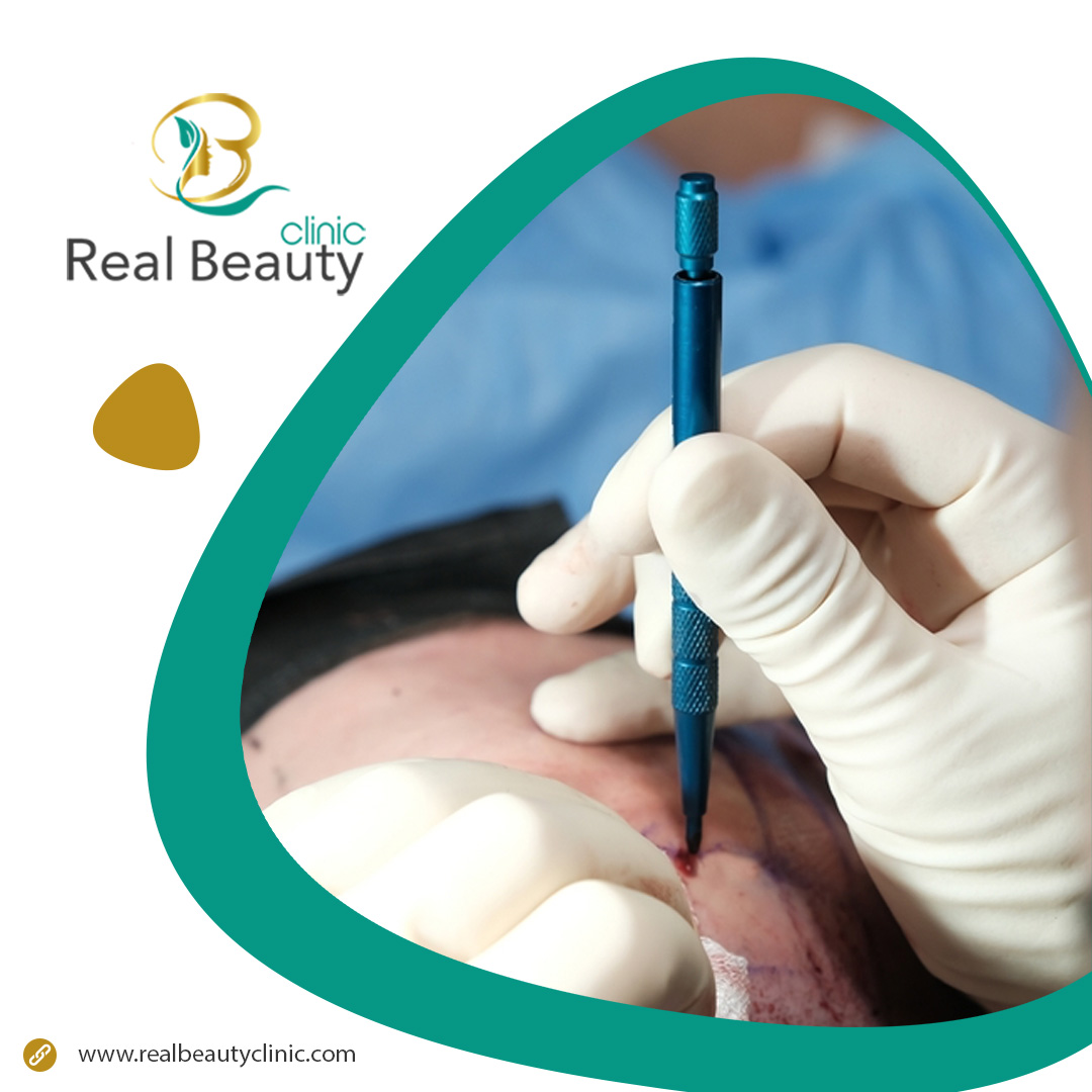 Sapphire Hair Transplant 2025: The Complete Guide for Natural, Lasting ...